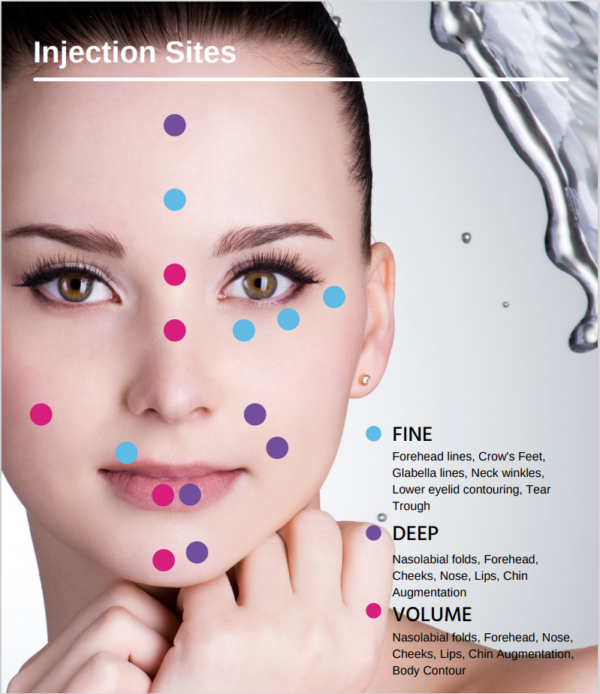 Nexfill Volume Lidocaine (1x1ml) - FillerDepot